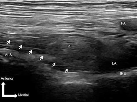Effect Of Pericapsular Nerve Group Block With Different Concentrations Jpr