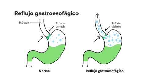 Reflujo Gastroesofágico Síntomas Y Tratamiento Portalclínic