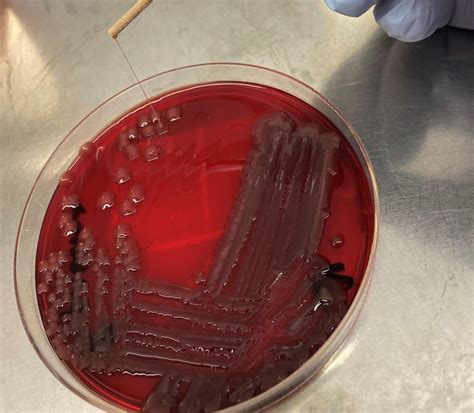 Positive String Test With A Hypervirulent Klebsiella Pneumoniae