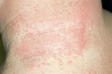 Itchy Rash On Face And Neck Only At Kathleen Perry Blog