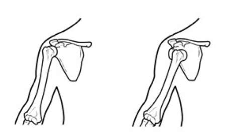 Multidirectional Instability Shoulder All You Need To Know