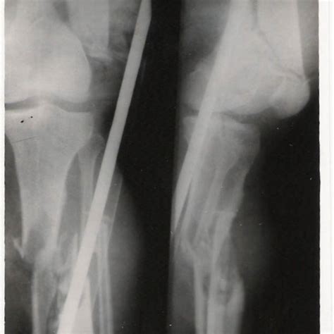 Pdf The Floating Knee Epidemiology Prognostic Indicators And Outcome