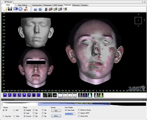Orthodontic Soft Tissue Parameters A Comparison Of Cone Beam Computed Tomography And The 3dmd