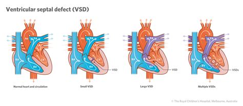 Ventricular Septal Defect Ecg
