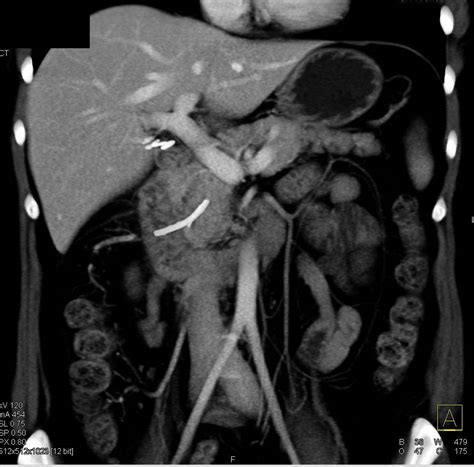 Endoscopic Biopsy Of Duodenum At William Trusty Blog