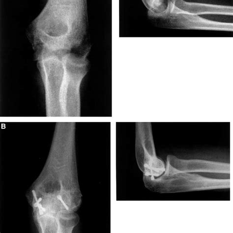 Pdf Herbert Screw Fixation Of Capitellar Fractures