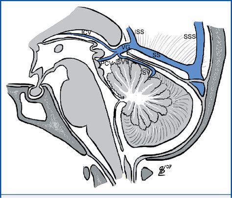 Precentral Cerebellar Vein Semantic Scholar
