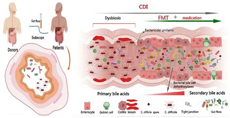 Inflammatory Bowel Disease And Clostridium Difficile Infection