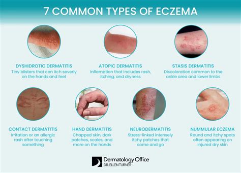 Understanding Eczema The 3 Most Common Types Of Eczema