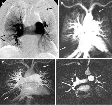Comparing Digital Subtraction Angiography Pulmonary Perfusion Magnetic