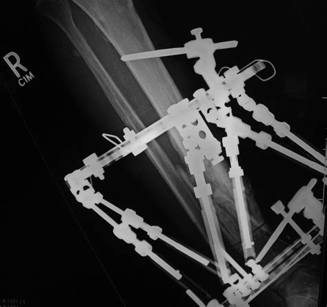 Medical Apparatus Imaging Guide Fracture Fixation