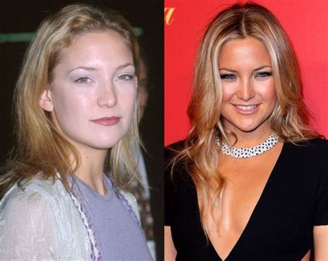 Kate Hudson Before And After Plastic Surgery 02 Celebrity Plastic