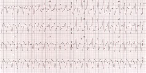 Ventricular Tachycardia Vt Clinical Features Diagnosis And