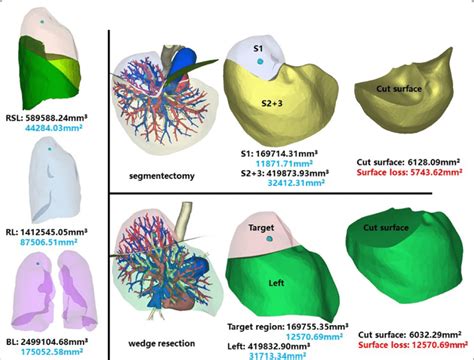 Segmentectomy Or Wedge Resection Of Rs1 Rsl Right Superior Lung Rl