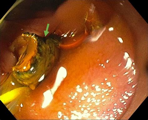 Endoscopic Retrograde Cholangiopancreatography Showing A 10 Mm Stone