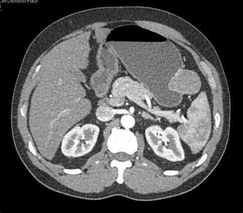 Gastric Gist Tumor Which Is Exophytic Stomach Case Studies Ctisus