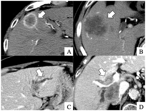A Preoperative Diagnostic Nomogram To Predict Tumor Subclassifications Of Intrahepatic