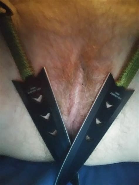 Marks Bruises Pics XHamster