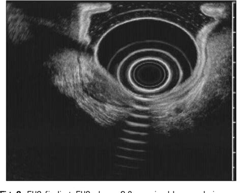 Figure 2 From A Case Of Gastric Lymphoepithelioma Like Carcinoma