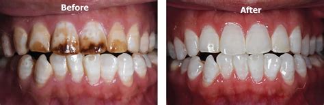 What Is Fluorosis Teeth At Natosha Guerro Blog