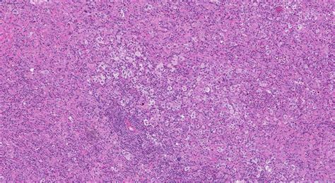 Classic Hodgkin Lymphoma Ottawa Atlas Of Pathology