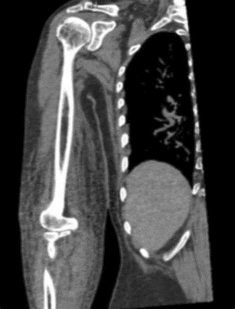 Computed Tomographic Examination Of The Right Upper Arm A Soft Tissue