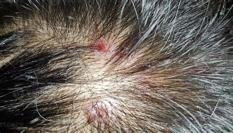 Scabs On The Scalp Wound On The Scalps Or Lichen Planus Follicularis Capillitii Itch On The