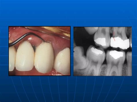 Classification Of Dental Caries Ppt