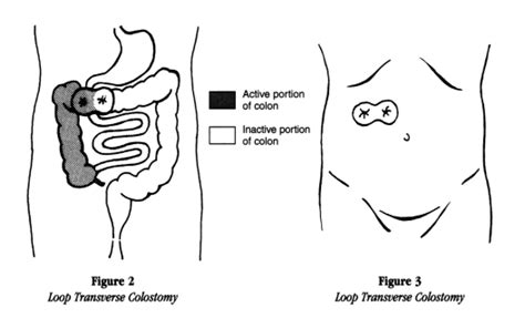 Colostomy Types American Cancer Society