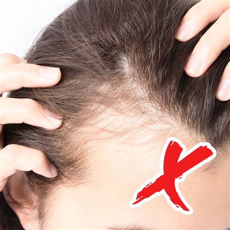 Want To Hide Bald Spots And Hair Loss Never Ask For These 5 ‘worst