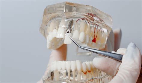 Root Canal Cap What Is It Types Cost And Post Treatment Care
