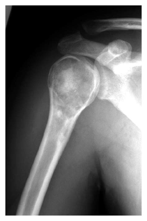 Conventional Radiography Ap View Of The Proximal Right Humerus A Download Scientific