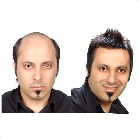 100 Percent Human Hair Wigs At 1000000 Inr In Hyderabad Wigs Designs