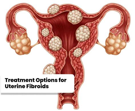 Uterine Fibroids Treatment Surgery Removal And New Options Doctorsapp