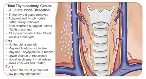 Minimally Invasive Thyroidectomy Larian Md