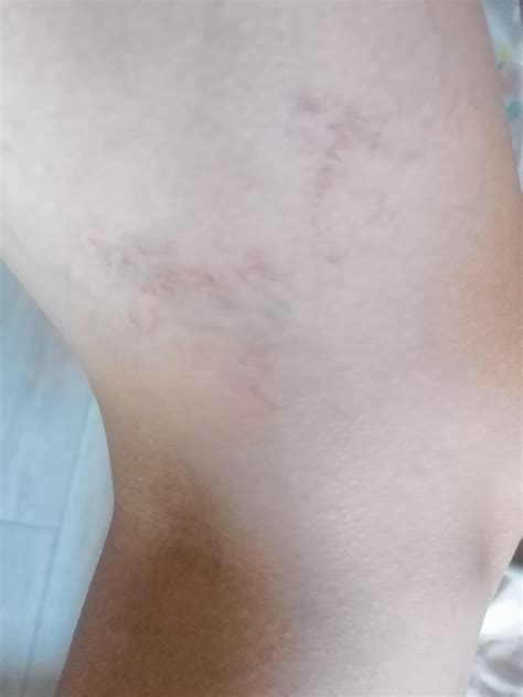 Разширени вени кой как се бори с проблема тема 4 Хронични заболявания Страница 5