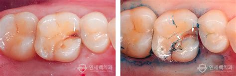 연세백치과 칼럼 균열치 치아에 금이 갔어요 씹을 때 찌릿하게 아파요