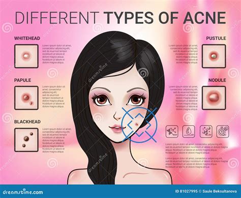 Infographics Of Different Type Of Skin Acne Stock Vector Illustration