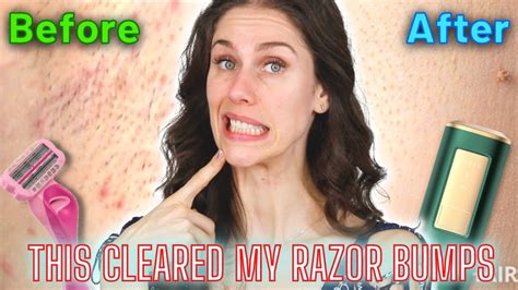 Razor Bumps Same Here Are Ways To Deal With Underarm Pimples And Razor Burn Youtube