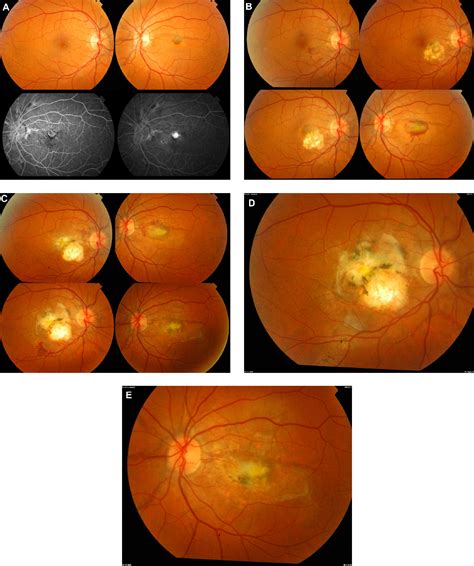 Figure 2 From Long Term Follow Up Of Choroidal Neovascularization