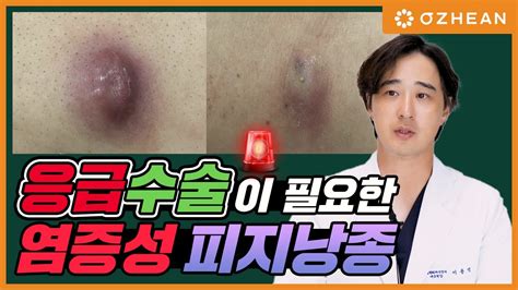 응급수술이 필요한 염증성 피지낭종 표피낭종 모기질종 피부 종기 양성종양 Youtube