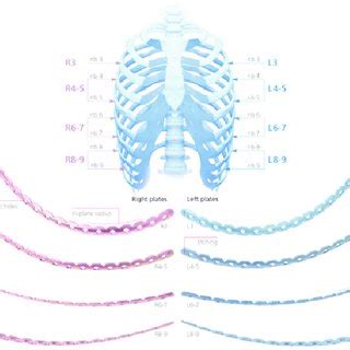 The Synthes Matix RIB Plating System Precontoured Titanium Alloy Download Scientific Diagram