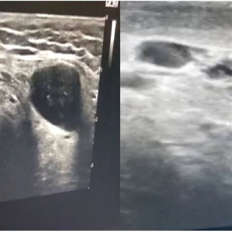Sonographic Picture Of Filaria Download Scientific Diagram