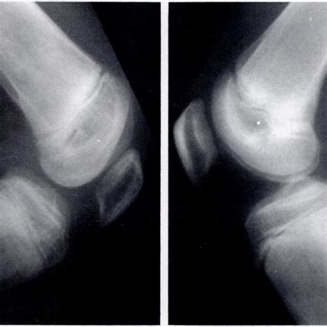 Pdf Congenital Snapping Knee Habitual Anterior Subluxation Of The