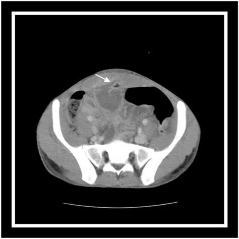 Types Of Urachal Anomalies A Patent Urachus B Urachal Sinus C