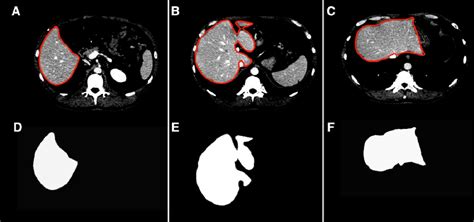Figure 1 From Accuracy Of A Semi Automated Liver Segmentation Method