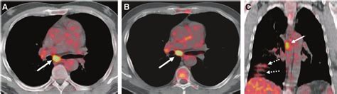 Subcarinal Lymph Node