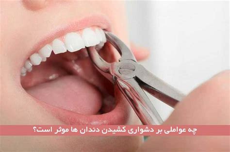چه عواملی بر دشواری کشیدن دندان ها موثر است؟ کلینیک دندان پزشکی دکتر شیدا