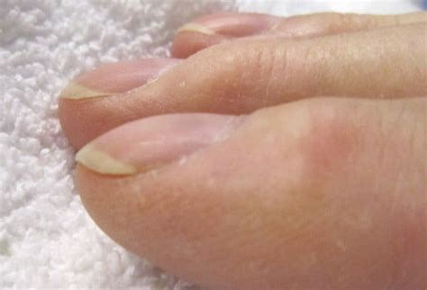 Fingernail And Toenail Abnormalities Nail The Diagnosis