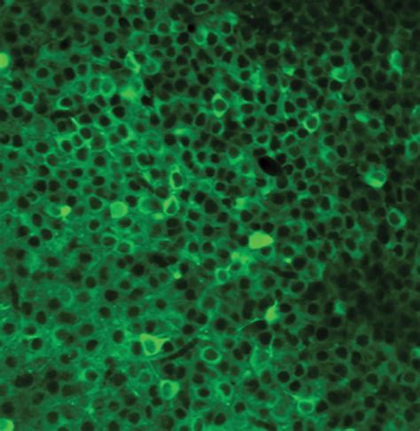 Schizophrenia And Memory Deficits Biological Origins Of Core